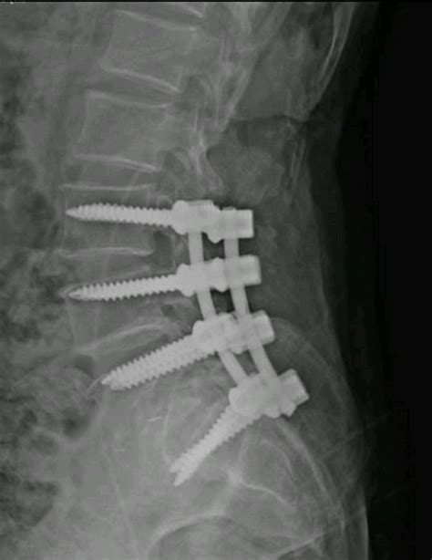 Ali Keipour On Linkedin The Patient Was A 60 Year Old Woman With A