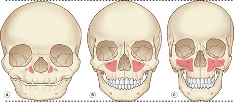 Pediatric Facial Fractures Clinical Tree