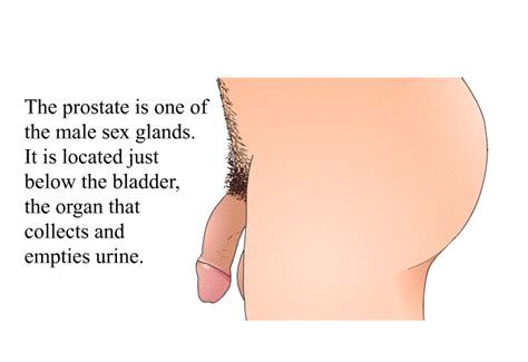Radiation Therapy For Prostate Cancer