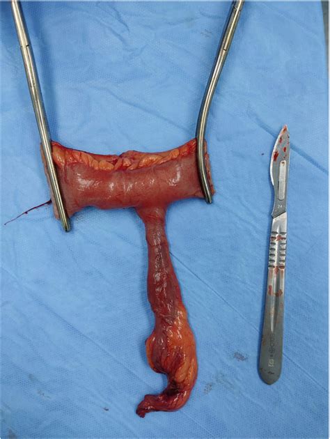 Product Of Enterectomy Resection With Meckels Diverticulum Download