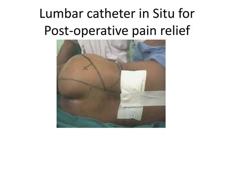Lumbar Sacral Plexus Blockppt