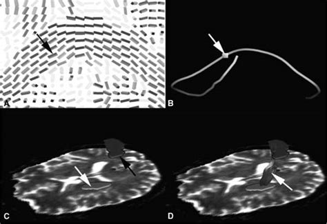 Diffusion Tensor Imaging Guided Resection Radiology Key