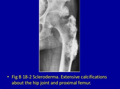 18 Generalized Calcification Or Ossification In Muscles And