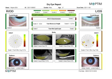 Dry Eye Analyzer Mibo Medical Group