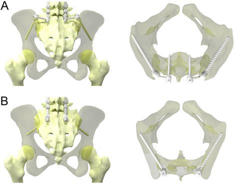 Lumboiliac Fixation Iliac Screws A Vs S2ai Screws B Download