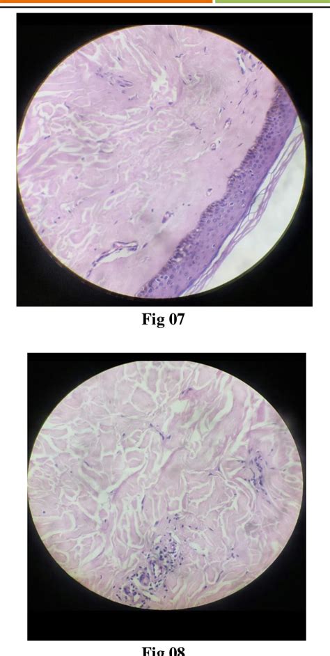 Figure 5 From Guttate Morphea A Rare Localised Scleroderma Variant