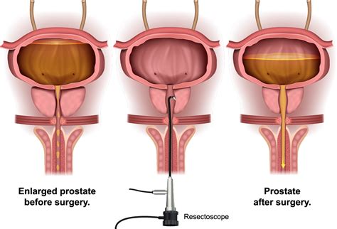 Turp Surgical Treatment For Bph