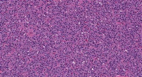 Follicular Thyroid Adenoma Ottawa Atlas Of Pathology