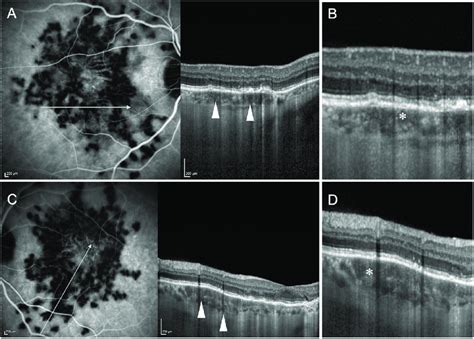 A Patient With Bilateral Choroiditis Lesions Of Acute Posterior
