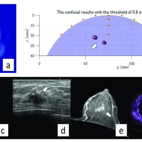 Representative Case Case 6 A 73 Year Old Woman With Invasive Ductal