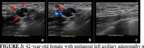 Figure 1 From Unilateral Axillary Adenopathy In The Setting Of Covid 19