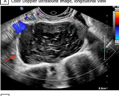 Figure 1 From Tarlov Cysts Mimicking Adnexal Masses Two Case Reports