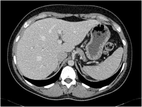Grade Liver Laceration After Cardiopulmonary Resuscitation 42 Off