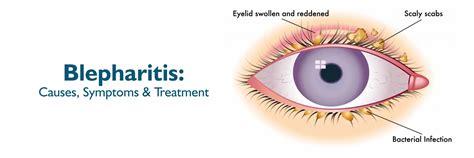 Anterior Blepharitis Microblepharoexfoliation Avant Eyes Optometry