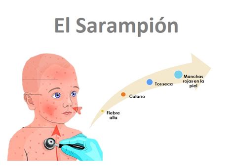 El Sarampión