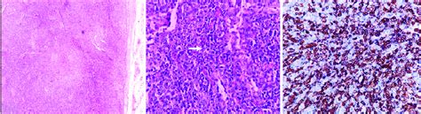 Photomicrograph Showing Effaced Lymph Node Architecture With Extensive