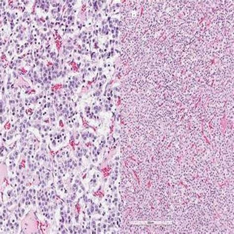 Moderately Cellular Cartilage Fragments Without Atypia A The