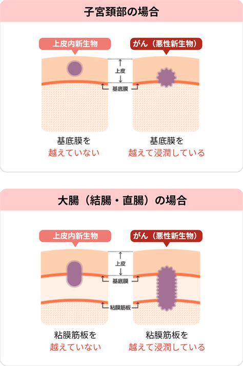 上皮内新生物とは？｜ライフネット生命保険