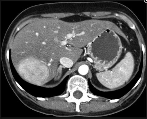 My Gastro Room Ctnon Cancerous Cystic Liver Lesions