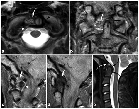 Transverse Ligament Cervical Spine