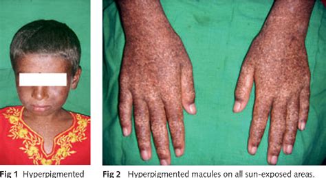 An Abnormalities Form In Dna Xeroderma Pigmentosum Xp