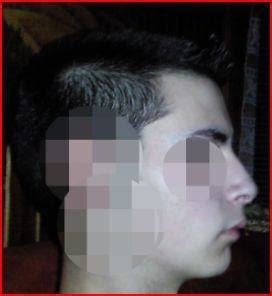 Ist Das Ein Fliehkinn Fliehendes Kinn