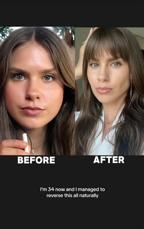 What Is Cortisol Face A Side Effect Caused By Stress