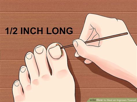 3 Ways To Heal An Ingrown Toenail Wikihow