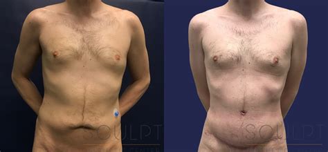 Tummy Tuck For Men In Frisco Sculpt Aesthetic Center