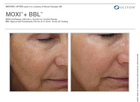 Moxi® Moxi® Laser Treatment For Face Becker Cosmetic