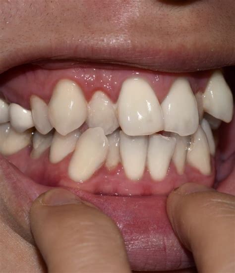 Overbite Underbite And Crossbite Bite Issues And Misalignment