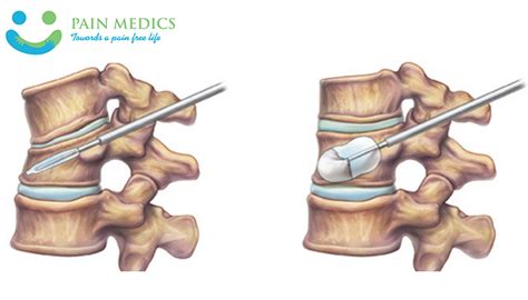 A Complete Guide To Percutaneous Vertebroplasty And Kyphoplasty