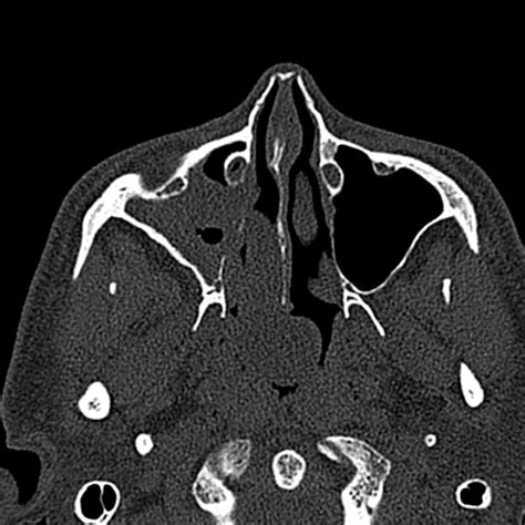 Antrochoanal Polyp Radiopaedia 30002 30554 Axial Bone Window Nc Commons