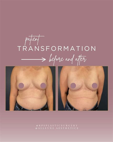 Breast Reconstruction Transformation Before And After With Alleyne Aesthetics This Beautiful