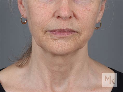 Facelift Before And After 06 Dr Michael Kim