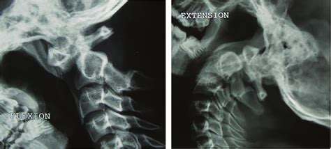 Upper Cervical Spine Computed Tomography Radiology Key