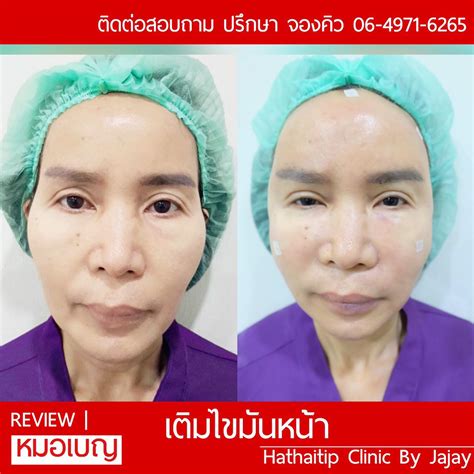 เติมไขม Haithaitip หทัยทิพย์ คลินิก สาขาพระราม2 สาขาใหญ่