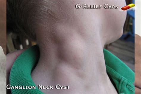 Ganglion Shoulder Cyst G Relief Caps Ganglion Surgery Alternative Fda
