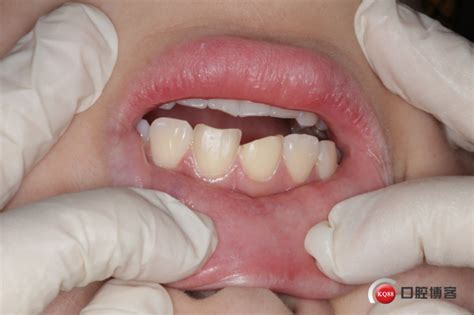 外伤冠折 铸瓷贴面修复 186hd1x8369的博客 Kq88口腔博客 外伤冠折 铸瓷贴面修复 186hd1x8369的博客 Kq88口腔博客