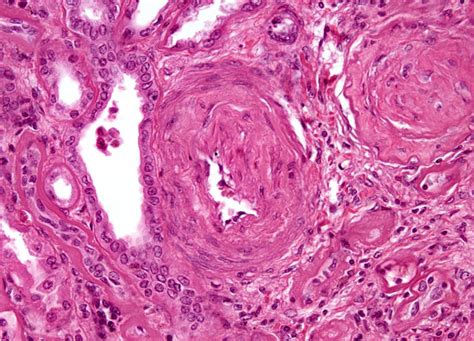 Hyperplastic Arteriosclerosis At 20x Magnification Nikons Microscopyu