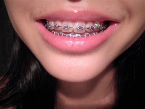 Braces Colors Teal And Pink Warehouse Of Ideas