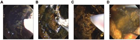A Step By Step Strategy For Calculi Extraction By Combining The Methods