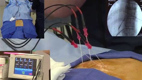 Radiofrequency Ablation Explanation Video Demonstration LIVE YouTube