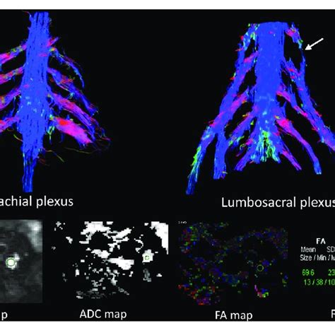 Diffusion Tensor Tractography Dtt Revealed Significantly Thickened