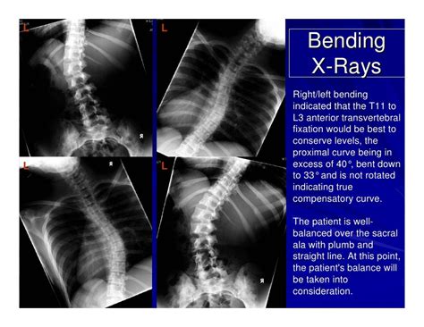 Case Review D 16 Year Old Female With Adolescent Idiopathic Scolios…