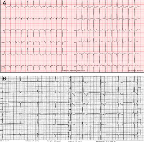 Electrocardiogram Recordings A Atrial Flutter Characterized By Download Scientific Diagram