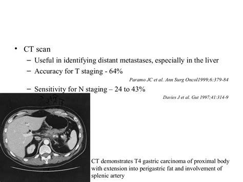 Staging And Surgery Of Gastric Carcinoma