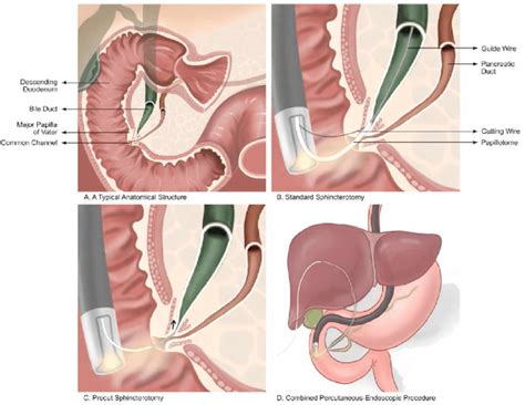 A A Typical Anatomical Structure B Endoscopic Biliary Download Scientific Diagram