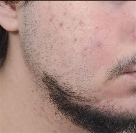 Post Inflamatory Erythema R30plusskincare