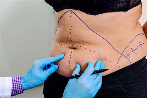 Vaser Liposuction ile Klasik Liposuction ın Farkı Nedir Op Dr